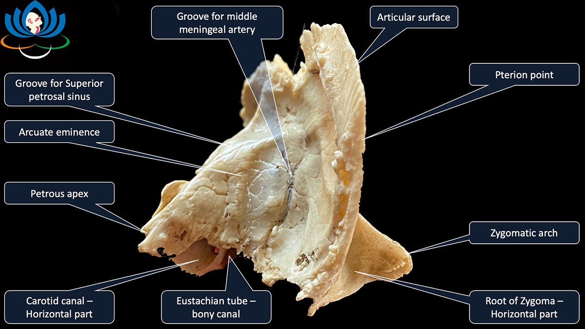 Anatomical Landmarks of the Temporal Bone: A Guide for Surgical Exercises