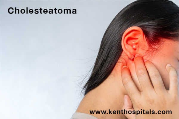 Cholesteatoma - https://www.kenthospitals.com Cholesteatoma ...