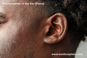 Perichondritis of the Ear (Pinna) - https://www.kenthospitals.com ...