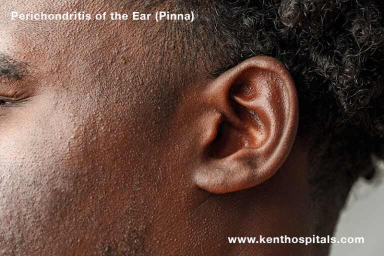 Perichondritis of the Ear (Pinna) - https://www.kenthospitals.com ...