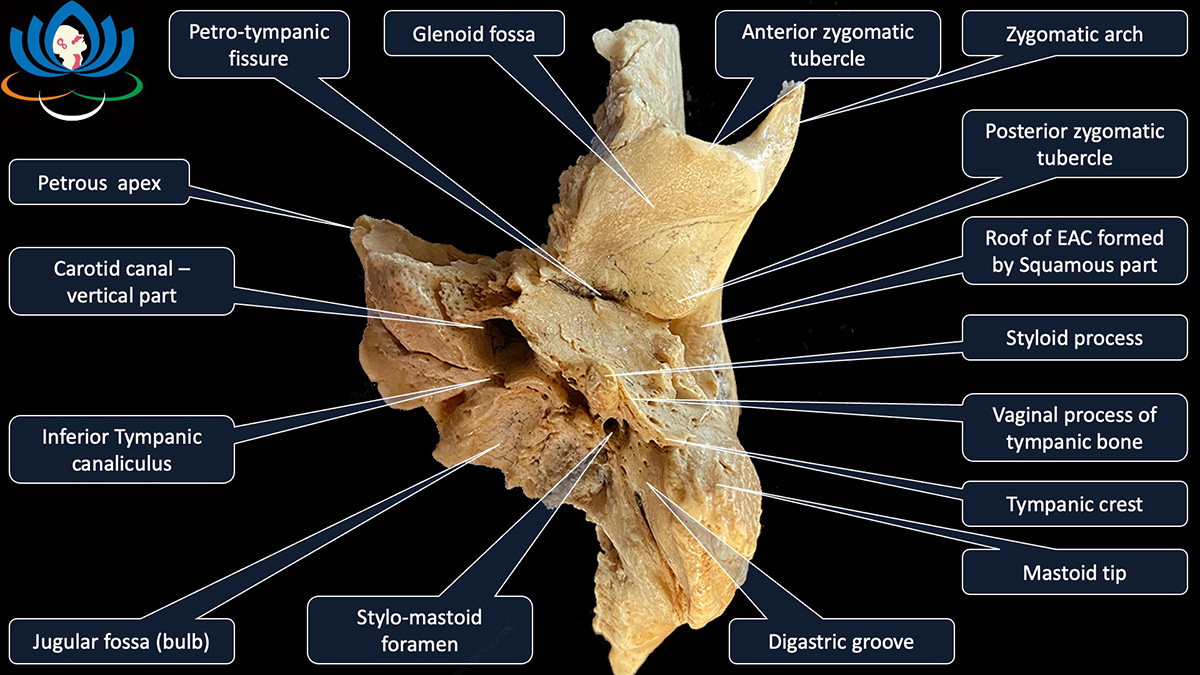 Anatomical Landmarks of the Temporal Bone: A Guide for Surgical Exercises
