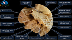 Anatomical Landmarks of the Temporal Bone: A Guide for Surgical Exercises