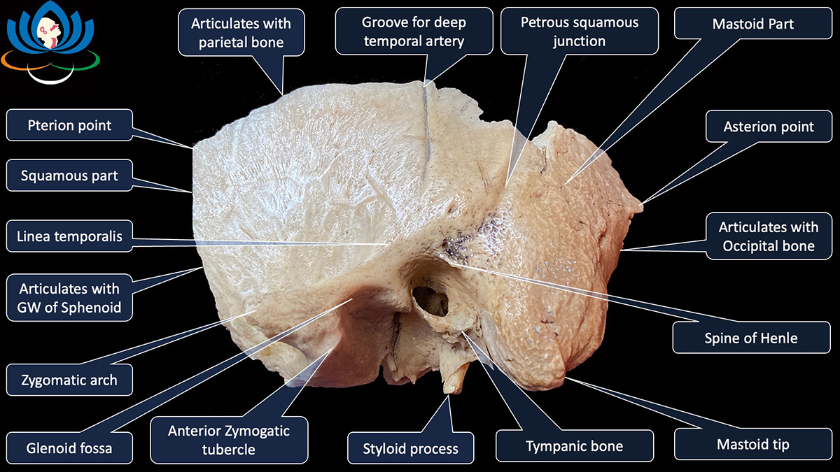 Anatomical Landmarks of the Temporal Bone: A Guide for Surgical Exercises