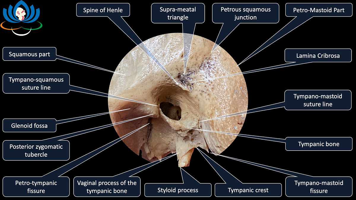 Anatomical Landmarks of the Temporal Bone: A Guide for Surgical Exercises