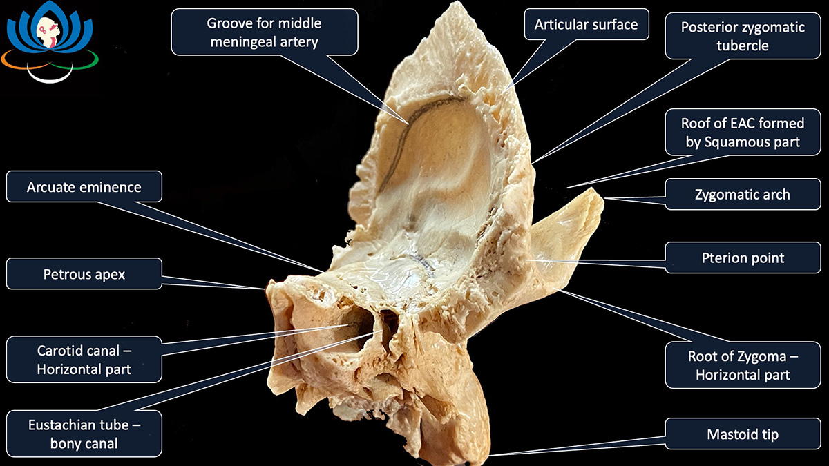 Anatomical Landmarks of the Temporal Bone: A Guide for Surgical Exercises