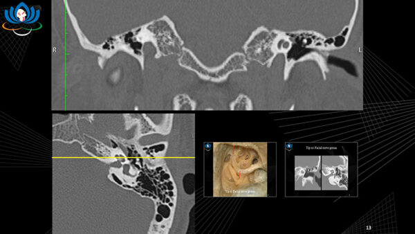 Master Temporal Bone Imaging: Online Certificate Course for ...